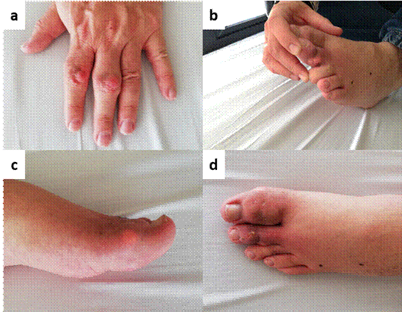 Tofos: (a) interfalángicas proximales de segundo y tercer dedo de mano ...